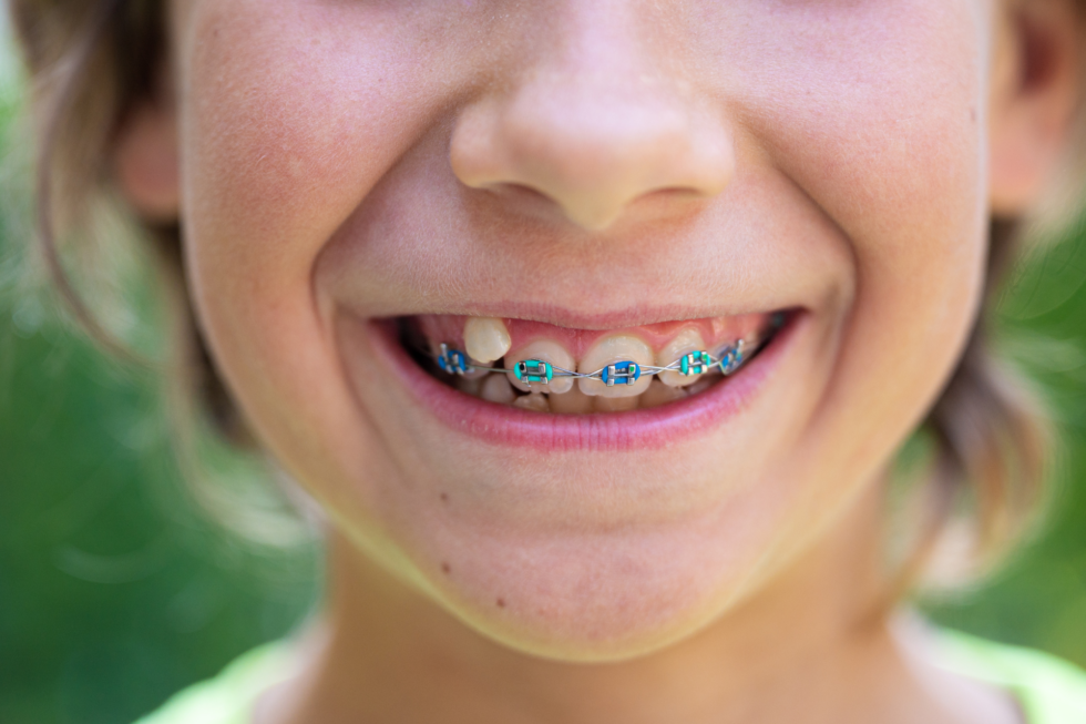 Ortho with Missing Teeth: Braces Not on Teeth | Great Smiles
